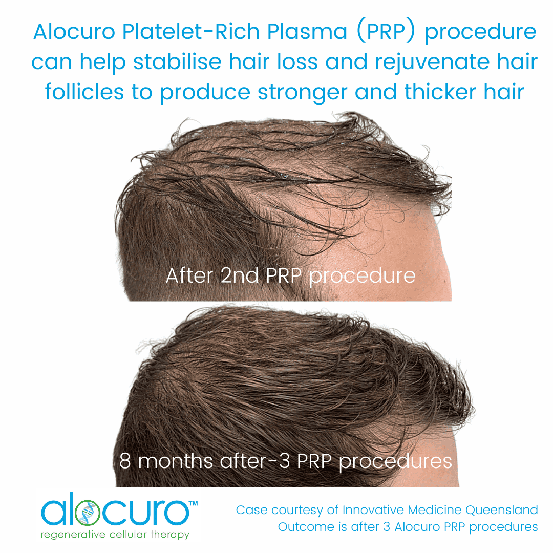 PRP ( Skin and Hair) pre and post care - Dermaluxe Beauty